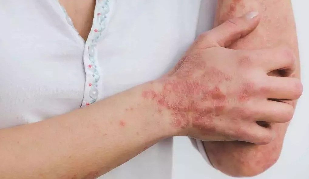 O infecție extrem de contagioasă face ravagii. Avertismentul medicilor ...