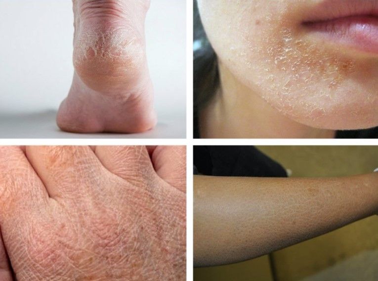 Trei semne de pe piele care pot indica deficiența unui nutrient ...