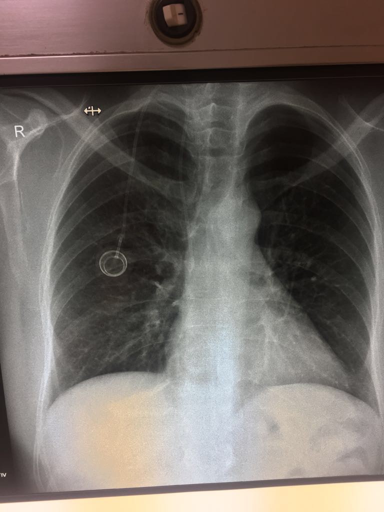 Cameră pentru citostatice, implantată subcutanat bolnavilor de cancer ...