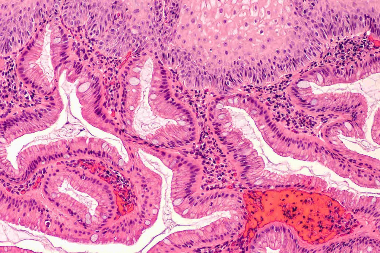 Sindromul Barrett sau esofagul Barrett: simptome, diagnostic și ...